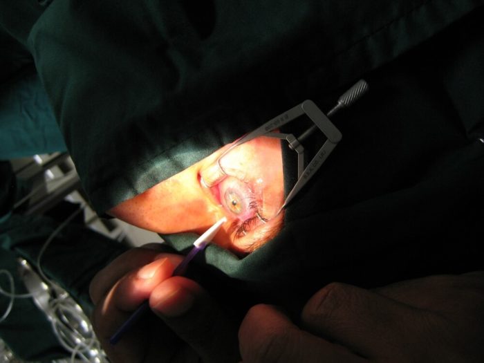 What Is Corneal Refractive Therapy?